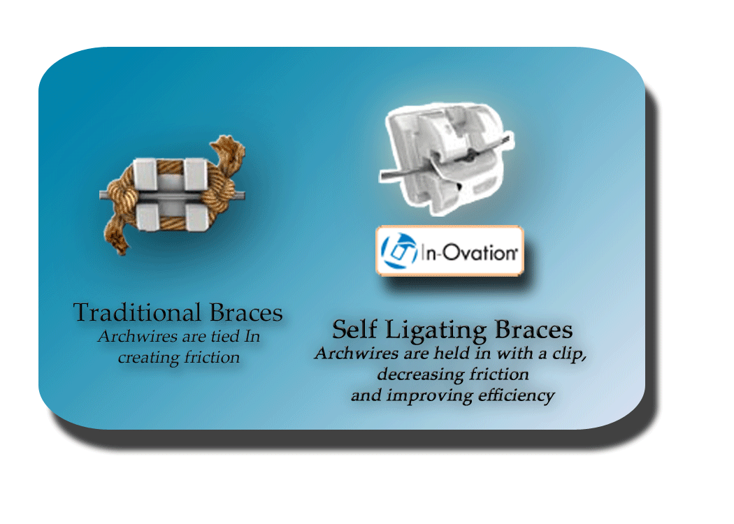 Types of Braces - Orthodontist Charlotte NC | Harris Orthodontics